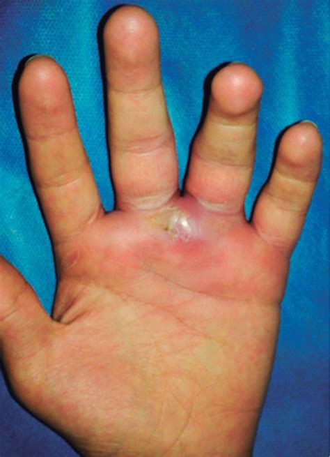 Diagnóstico Y Tratamiento De Las Infecciones Agudas De Mano