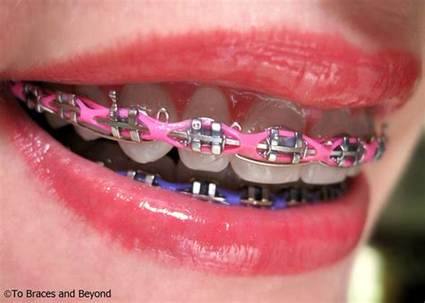 Cute Braces Colors For Girls Teeth