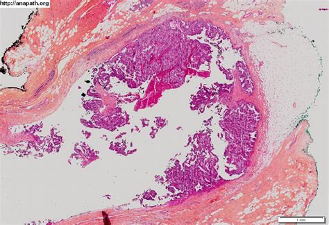 Carcinome Canalaire Du Sein Cancer Canalaire Infiltrant Du Sein