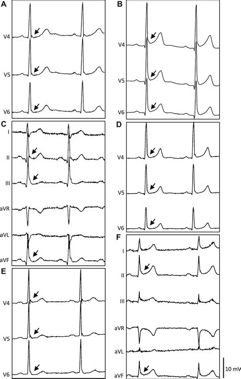 Ventricular And Supraventricular Ectopy In Subjects With Early