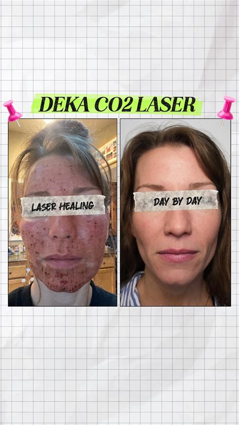 Deka Laser Recovery