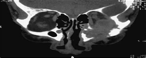 Supraestructure Maxillectomy And Orbital Exenteration For Tr Journal Of Cancer Research And