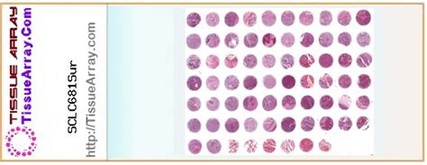 Sclc681sur Lung Small Cell Carcinoma And Normal Tissue Microarray With