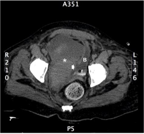 Pelvic Hematoma A Rare Cause Of Bladder Perforation And Gross