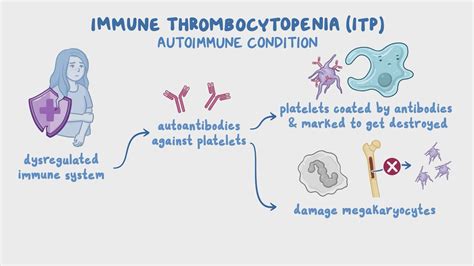 Video Immune Thrombocytopenia Clinical Sciences Osmosis