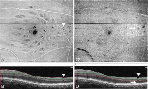 Internal Limiting Membrane Peeling Distorts The Retinal Laye Retina