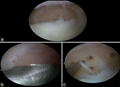 Anatomical And Cost Effective Technique Of Fixation Of Osteochondral Defect Of Femur With