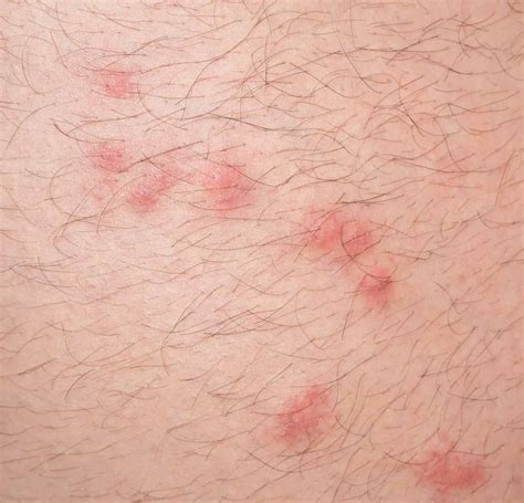 Flea Bites On Arms