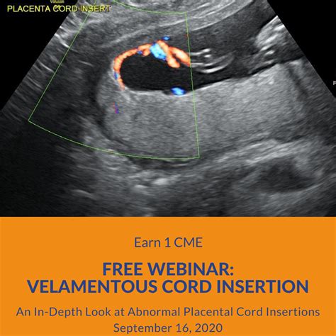 Velamentous Cord Insertion Ultrasound