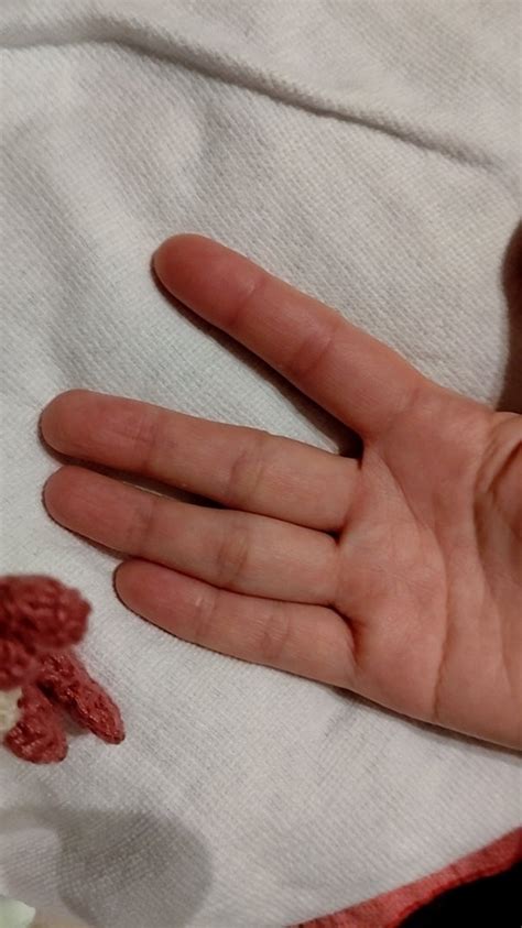 帯状疱疹との付き合い方 ー