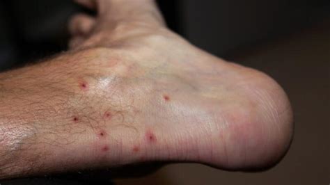 Bug Bite Pictures Symptoms Identification Treatment And More