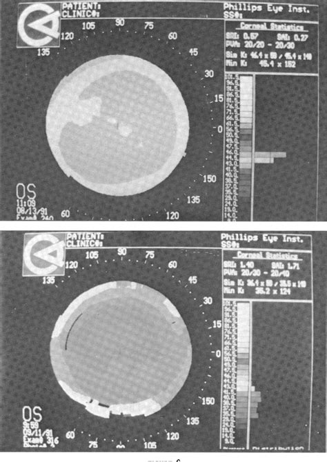 Figure 6 From Excimer Laser Photorefractive Keratectomy In High Myopia
