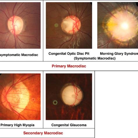 Pdf Optic Nerve Head Anatomy In Myopia And Glaucoma Including