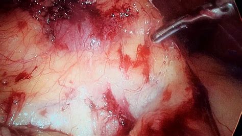Laproscopic Right Radical Nephrectomy Kocherization And Demonstration
