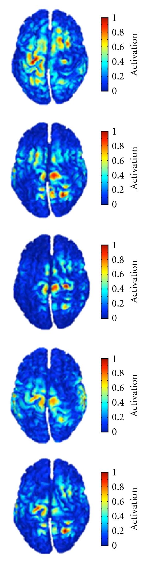 Cortical Source Activation Maps Produced By Econnectome After Solving