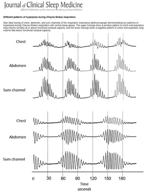Cheyne Stokes Breathing Pattern