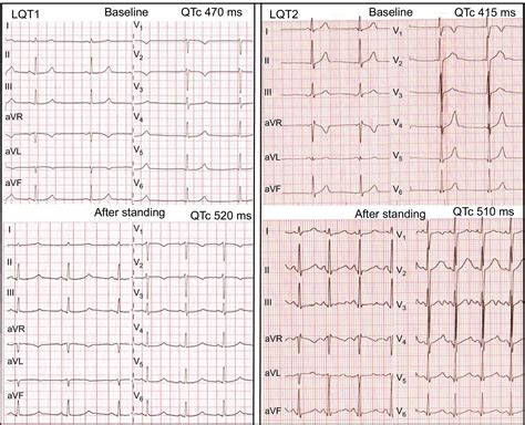 Value Of The “standing Test” In The Diagnosis And Evaluation Of Beta