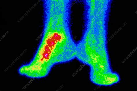 Algodystrophy Scintigram Stock Image C001 8077 Science Photo Library