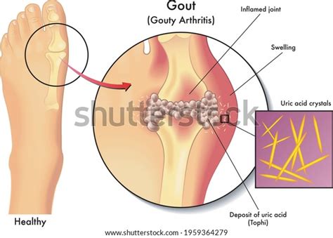 Medical Illustration Symptoms Gout Stock Vector Royalty Free Shutterstock