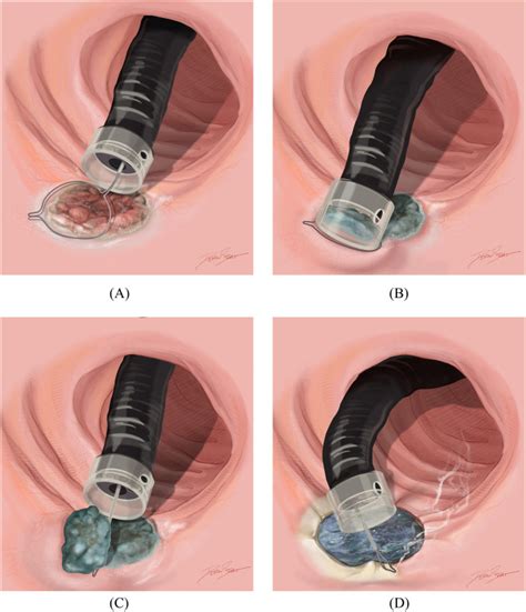 Endoscopic Ablation Of Polyp At Victoria Mcbrien Blog