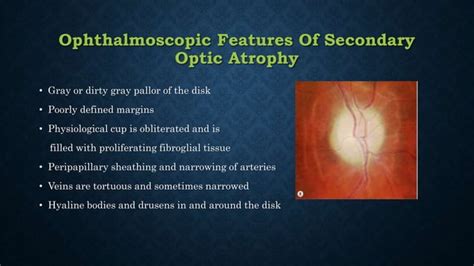 Optic Atrophy Ppt Pptx