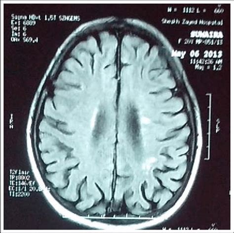 Mri Showing Demyelination In Deep White Matter Arrow Download