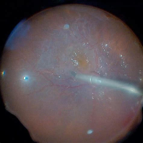 Mohamed Tawfik On Linkedin Retinal Rotation When You Do 360