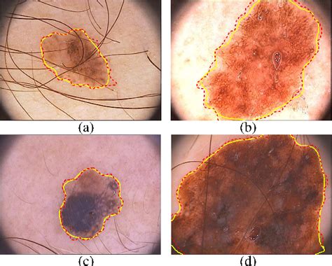 Figure 6 From Automatic Skin Lesion Segmentation Using Deep Fully Convolutional Networks With