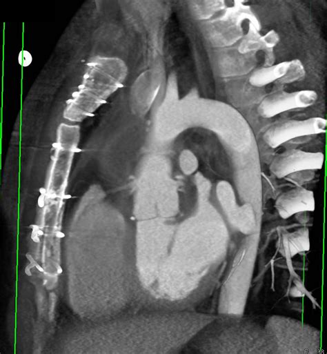 Aortic Root And Ascending Aorta Repair Note The Thrombus On Aortic Valve Leaflet Cardiac