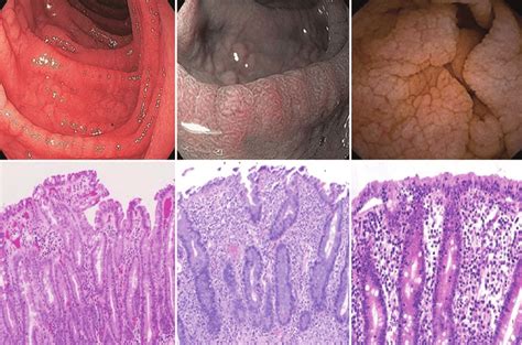 Endoscopic View Of The Duodenum And Histologic Findings In Celiac Download Scientific Diagram