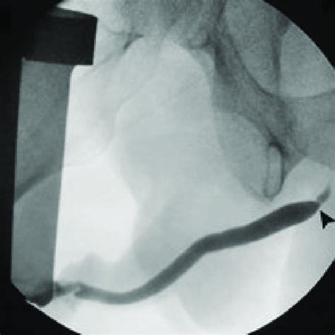 Retrograde Urethrogram Shows Proximal Short And Narrow Bulbar Urethral