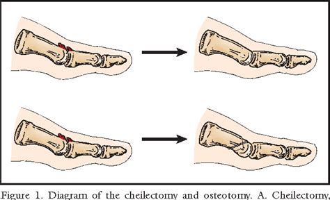 Hallux Rigidus Cheilectomy