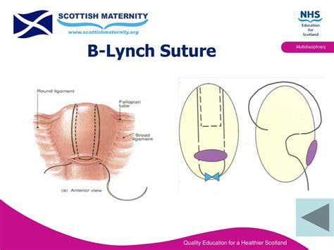 Ppt Obstetric Haemorrhage Powerpoint Presentation Free Download Id