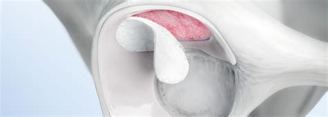 Geistlich Pharma Ag International Pharma Amic Hip