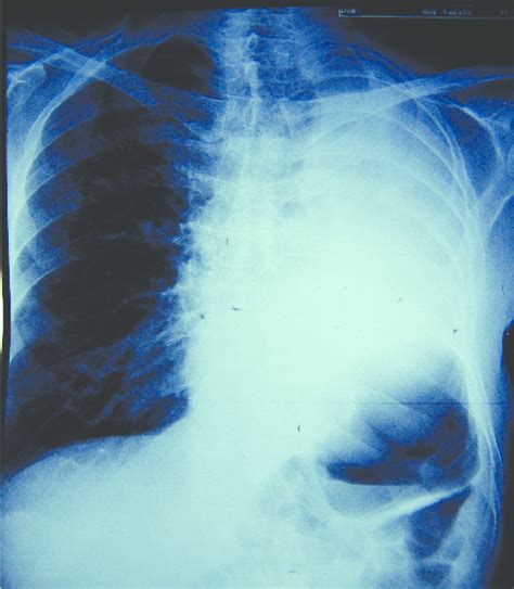 Fibronodular Infiltration At Right Lower Zone On Chest X Ray