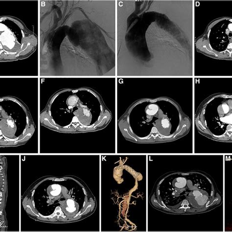 A Three Dimensional 3d Reconstruction Of Preoperative Surgery Cta