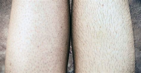 Rash On Legs From Shaving
