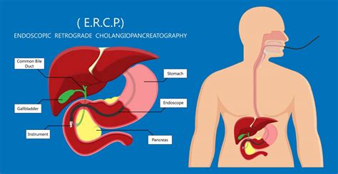 Endoscopic Retrograde Cholangiopancreatography Ercp Aliveomedical
