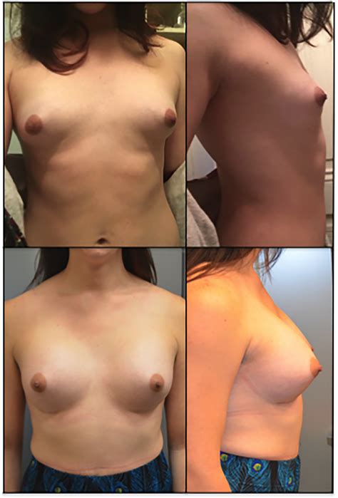 Breast Augmentation In Male To Female Transgender Patients Technical