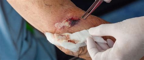 Serosanguineous Drainage Guide Causes Color And Care Tips