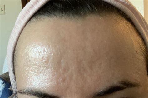 Routine Help Forehead Texture Nothing Seems To Help Routine In