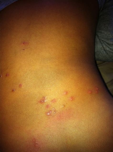 Bed Bug Bites Vs Chicken Pox Moreoo