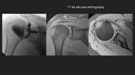 Shoulder Mr Arthrogram 31m With Pain 6 Weeks After Fall Ocad Shoulder Mr Arthrogram 31m With Pain 6 Weeks After Fall Ocad