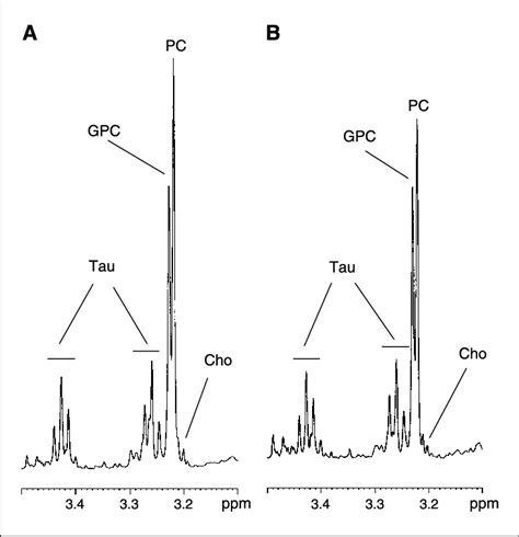Phosphocholine Levels Was Found To Be Decreased Significantly In The