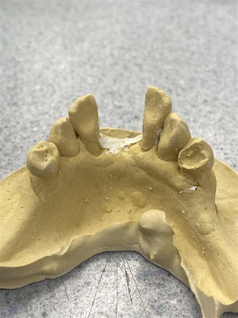 Doctor “please Make Clear Tooth Extractor I Mean Retainer” Rdentallab