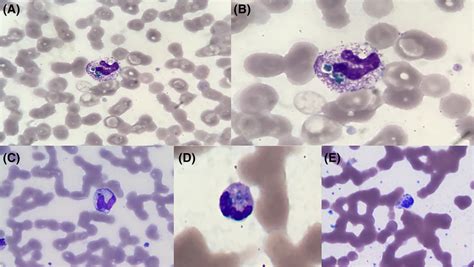 Peripheral Smear Showing Granulocytes And A Monocyte With Bright
