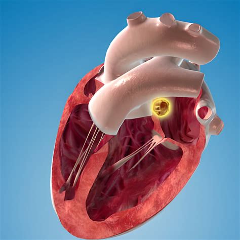 Thrombus In Left Atrium Medicalgraphics