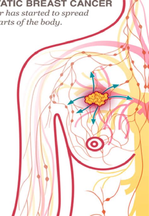 Figure 1 From Automatic Classification Of Sentinel Lymph Node Sln Metastases In Breast