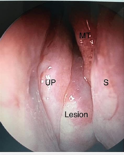 Endoscopic View Of The Lesion Up Uncinate Process S Septum Mt