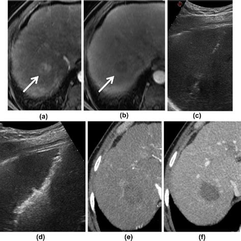 Treatment Of Intermediate Stage Hcc With Tace With Drugeluting Beads In